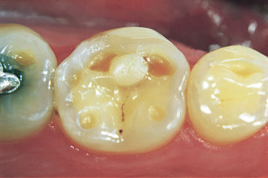 Erosioner – syreskader på tænderne - Tandlægeforeningen